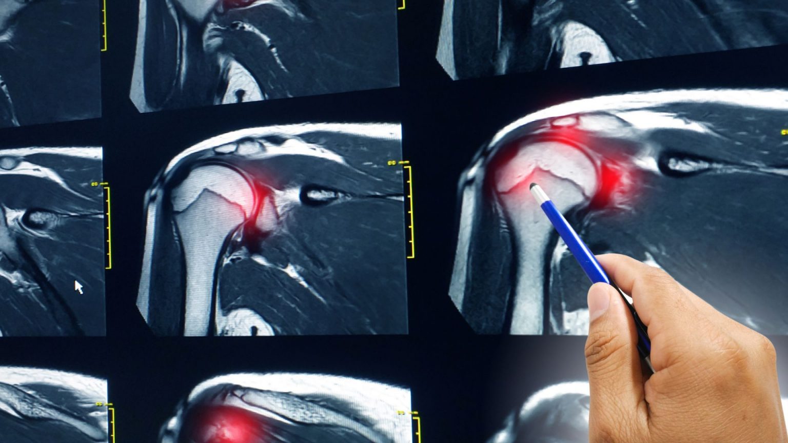 Lesione massiva di cuffia: fisioterapia si! - FisioScience CLUB